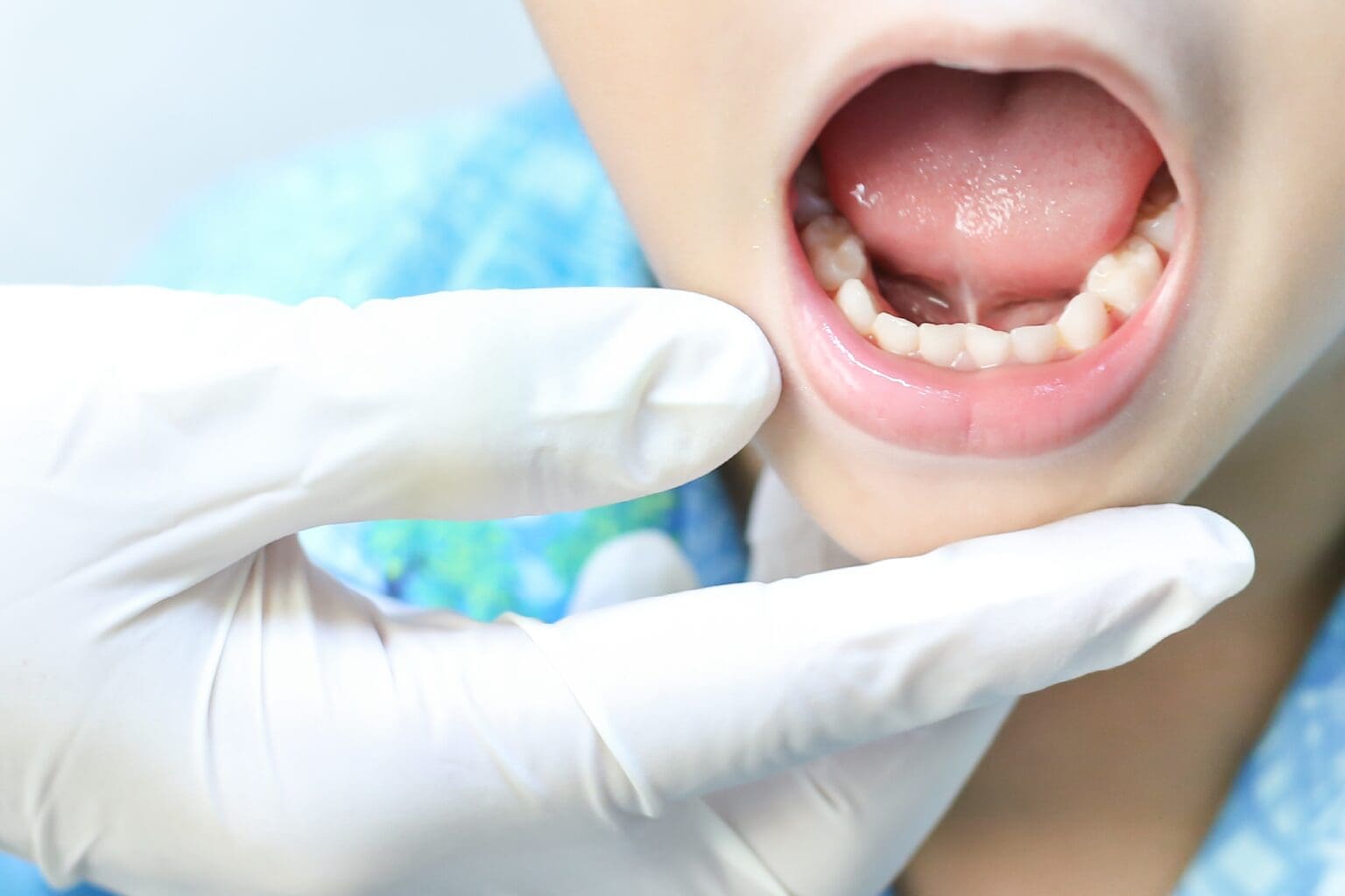 Ankyloglossia (Tongue-tie) - ENT Health